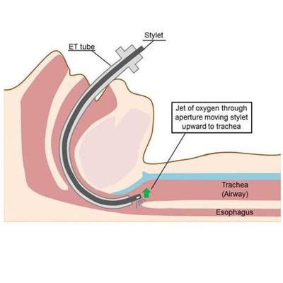 Esophageal Tracheal Tube Vs Endotracheal Tube