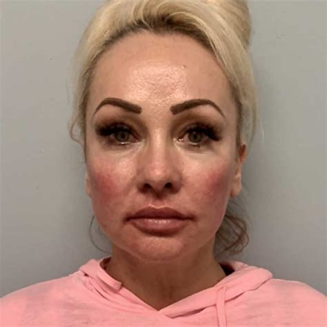 Before After Lip Augmentation In Murrieta CA Lucali