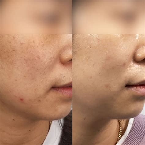 피코토닝 레이저토닝 차이 피코토닝만의 효과 전후 사진 Best 주기는 강남언니 1등 성형수술and피부시술 정보앱