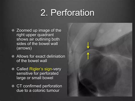 Approach To Pfa Interpretation Pptx Digestive Disorders Diseases