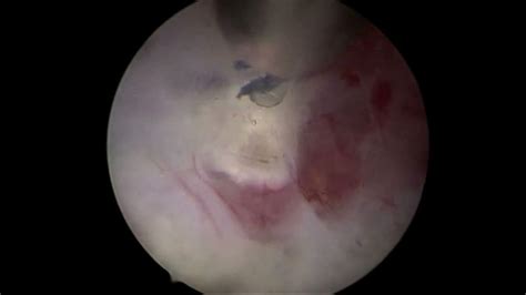 Holep Bilobar Prostatectomy 130 Gr Uneditted Full Video Youtube