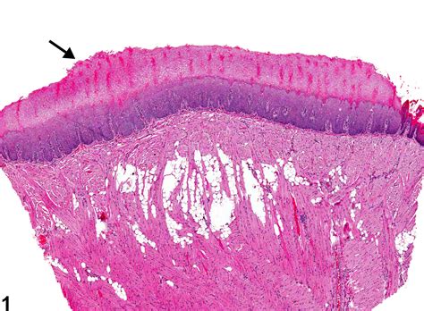 Hyperkeratosis Histology