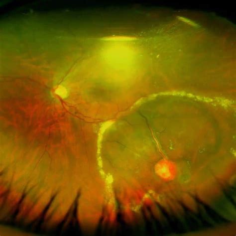 Retinal Capillary Haemangiomas Peripheral And Juxtapapillary