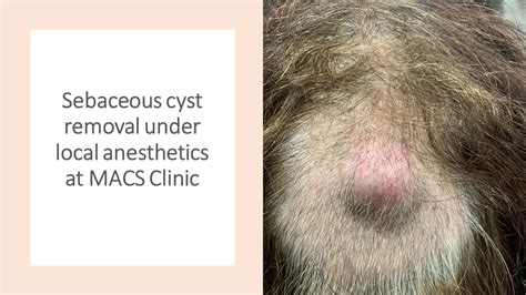 Understanding Sebaceous Cysts Pillar Cysts Causes Symptoms And