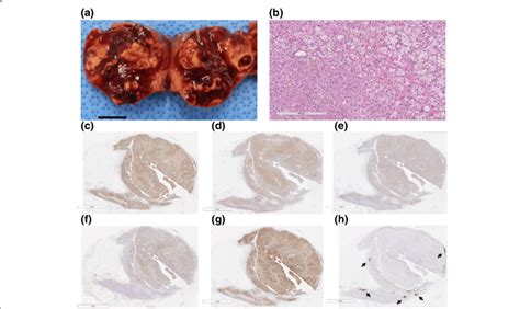 Histopathological Examination Of Adrenal Adenoma A Macro Image Of The