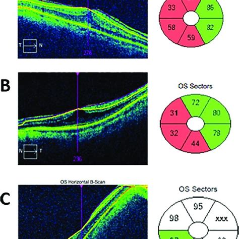 Segmentation On The Original Image Retinal Layers Are As Follows