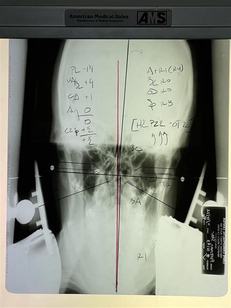 Connection Between Upper Cervical Misalignment And Eustachian Tube
