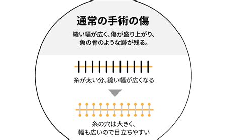手術後426日目 包茎手術後の記録