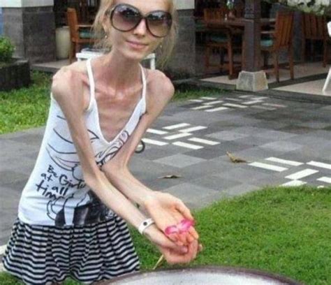 俄羅斯一女子減肥過度患厭食症，如今她的體重只有40斤！ 每日頭條