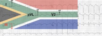 High Lateral Stemi • Litfl • Ecg Library Diagnosis