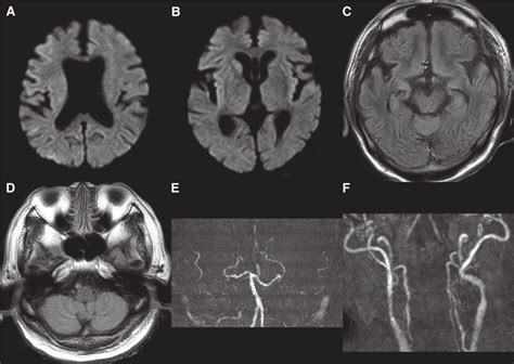Brain Mri And Mra About 90 Minutes After Onset A And B Download