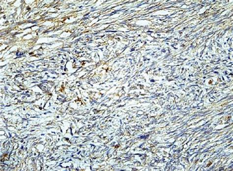 The Protein Expression Of Tgf β2 And Tgf β3 In Human Ovarian Cancer And