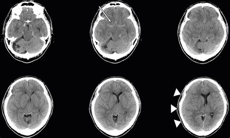 Right Parietal Convexity