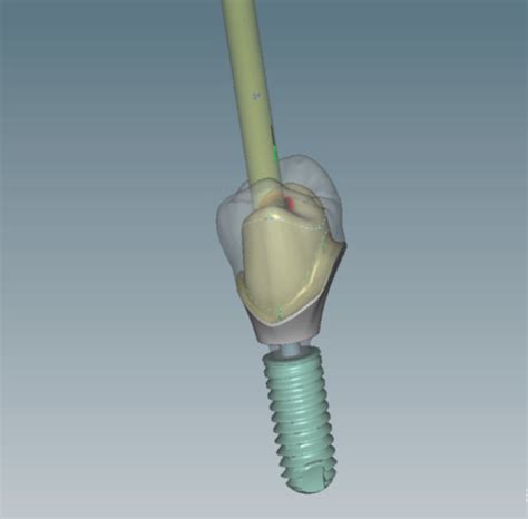 divergent angle of implant trajectory and agglutination correction