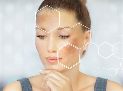 Hyperpigmentation Remedies