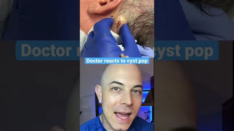 An Amazing Cyst Pop That You Won T Believe