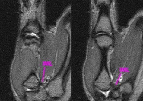 Mri Musculo Skeletal Section Thumb Carpo Metacarpal Joint