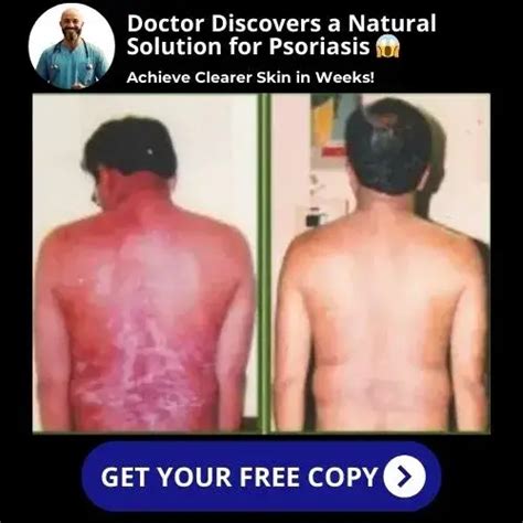 Psoriasis Diet Foods To Include And Avoid For Healthier Skin Psodoc