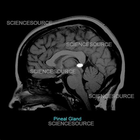 Pineal Gland Sagittal Mri Stock Image Science Source Images