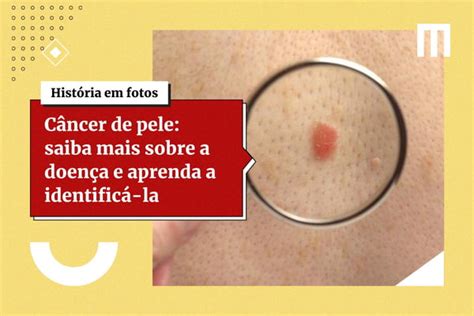 Melanoma Acral Câncer De Pele Grave é Mais Comum No Norte Do País