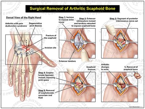 Surgical Removal Of Arthritic Scaphoid Bone Illustration
