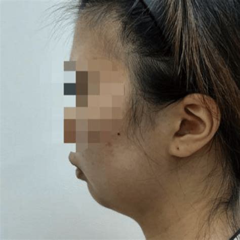 파워v얼굴지방흡입 이중턱 근육묶기 실리프팅 후기 닥터정 리반의원