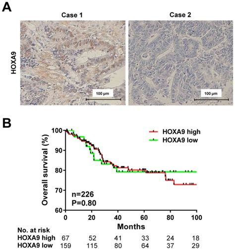 Upregulated HOXA Expression Is Associated With Lymph Node Metastasis In Colorectal Cancer