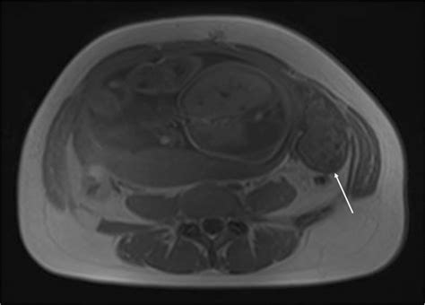 Axial Fat Saturated T1 Weighted Magnetic Resonance Imaging Mri Shows