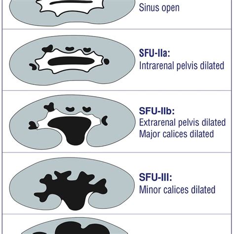 Radiology Hydronephrosis Grading System Download Scientific Diagram