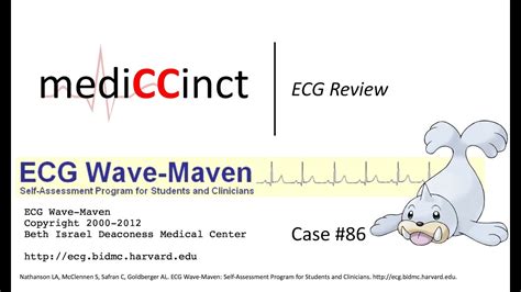 Acutehyperacute Anterior Wall Q Wave Myocardial Infarction Ecg Wave