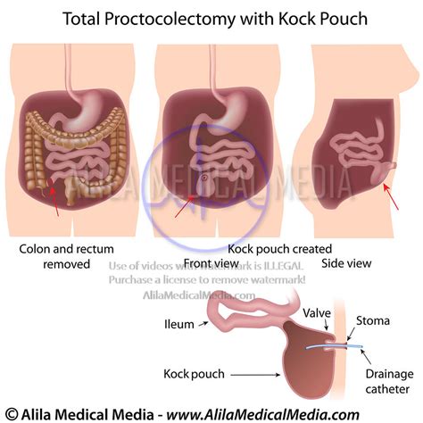 Alila Medical Media Total Proctocolectomy With Kock Pouch Medical Illustration