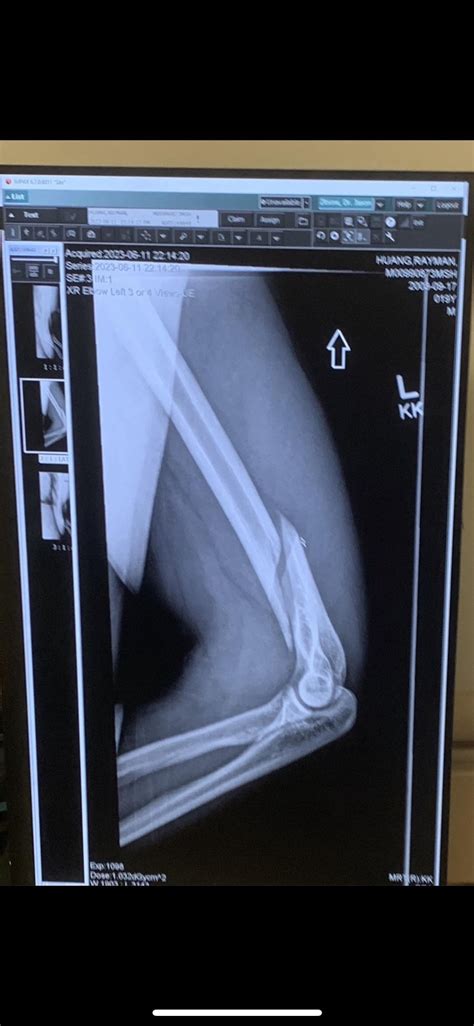 6 Week Update After Orif For Distal Radius Fracture R Brokenbones