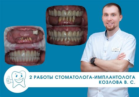 Тотальное протезирование с опорой на имплантаты | Стоматология Улыбка