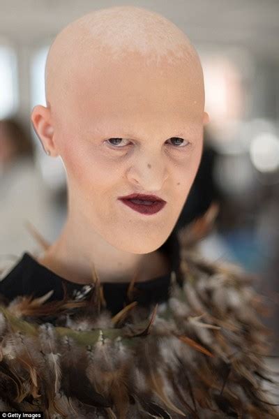 Ectodermal Dysplasia Genetic Disorder Left Model With No Tooth Pores
