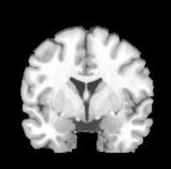 Neuro Multiple Choice Flashcards Quizlet