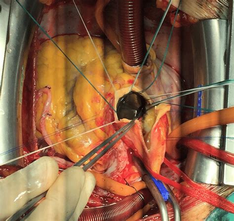 The Aortotomy Incision Was Started Approximately 2cm Above The Right Download Scientific