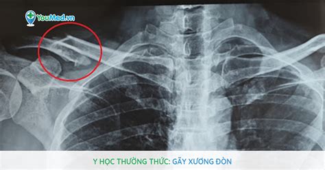 Gãy xương cánh tay Nguyên nhân triệu chứng và cách điều trị YouMed