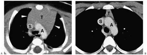Mediastinum Radiology Key