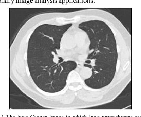 Figure 1 From Lung Nodule Segmentation In Ct Images Using Rotation