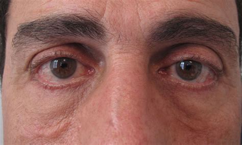 Cernes Et Botox Centre Ophtalmologique Saint Paul