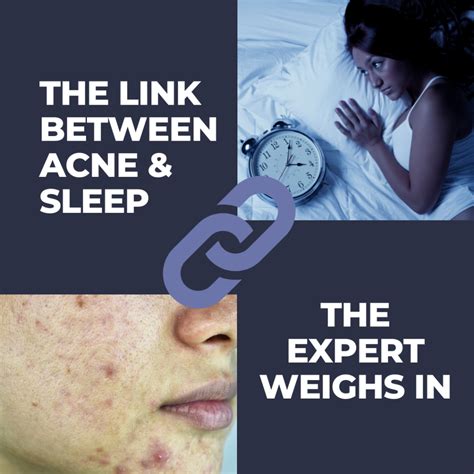The Link Between Acne And Sleep The Expert Weighs In Next Steps In