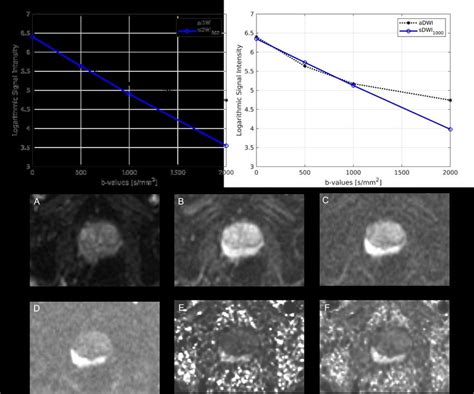 Comparison Of Synthesized And Acquired High B Value Diffusion Weighted Mri For Detection Of