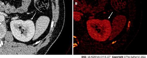 Figure 3 From Recent Advances In Imaging Techniques Of Renal Masses