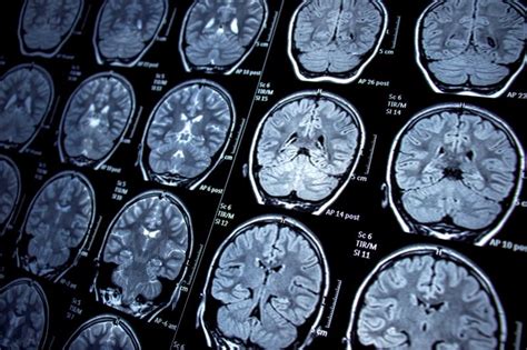 Thruday On Linkedin Neurotransmitters Adhd And You A Guide To Your Brain