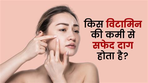 किस विटामिन की कमी से स्किन पर सफेद दाग होते हैं । Which Vitamin