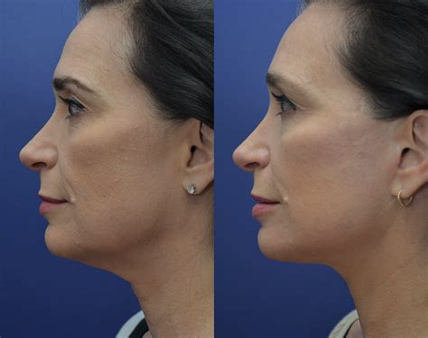 Patient 5930601 Facelift Gallery Tansavatdi Facial Plastic Surgery