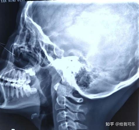 腺样体肥大 知乎