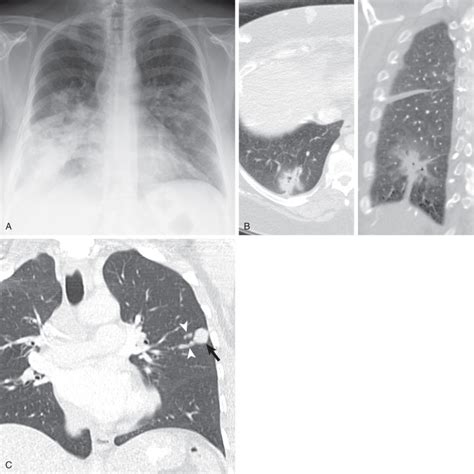 Fungal Infections Radiology Key