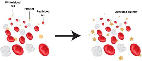 Immature Platelet Fraction Ipf And Its Clinical Utility In Dengue