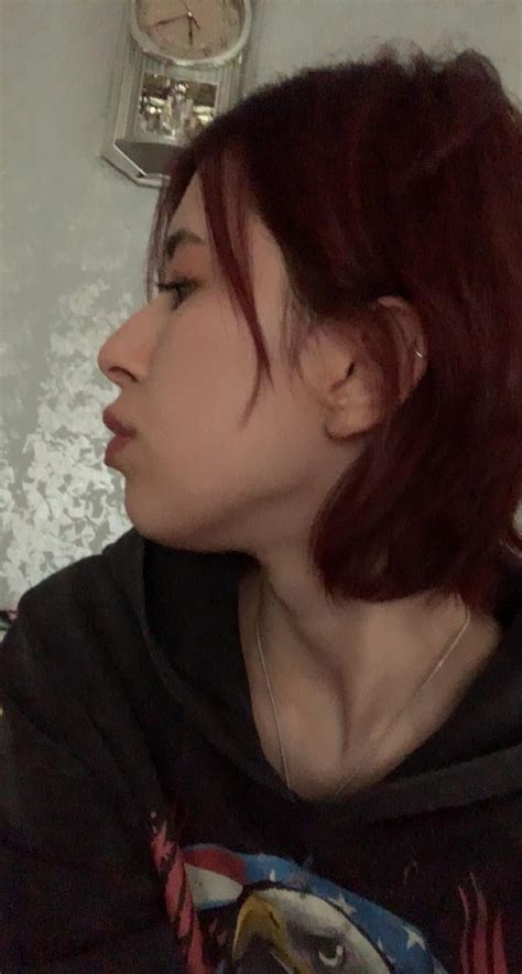 25 Months Post Op Rhinoplasty Rplasticsurgery